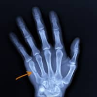 Management of Common Upper Extremity Sport Injuries – Cogent Steps, LLC